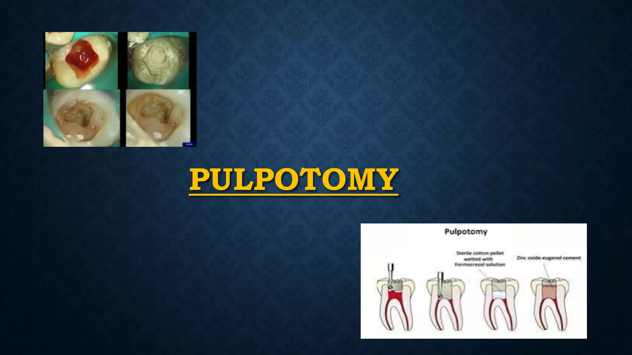 Pediatric Endodontics - Indirect and Direct pulp capping,Pulpotomy ...