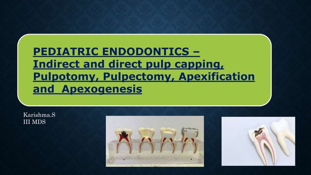 Pediatric Endodontics - Indirect and Direct pulp capping,Pulpotomy ...