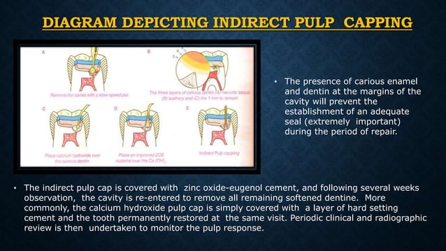 Pediatric Endodontics - Indirect and Direct pulp capping,Pulpotomy ...