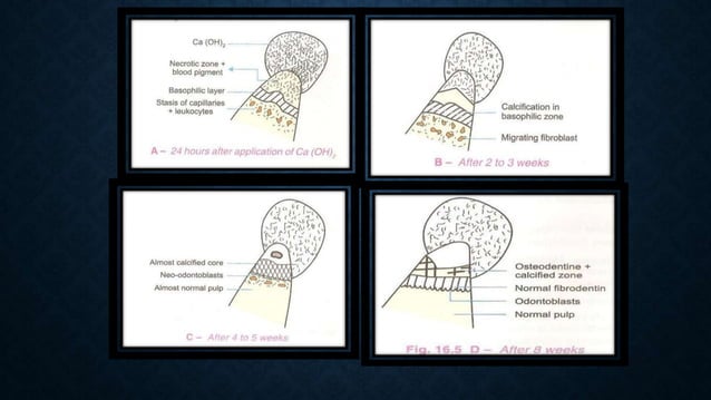 Pediatric Endodontics - Indirect and Direct pulp capping,Pulpotomy ...
