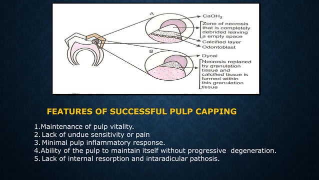 Pediatric Endodontics - Indirect and Direct pulp capping,Pulpotomy ...