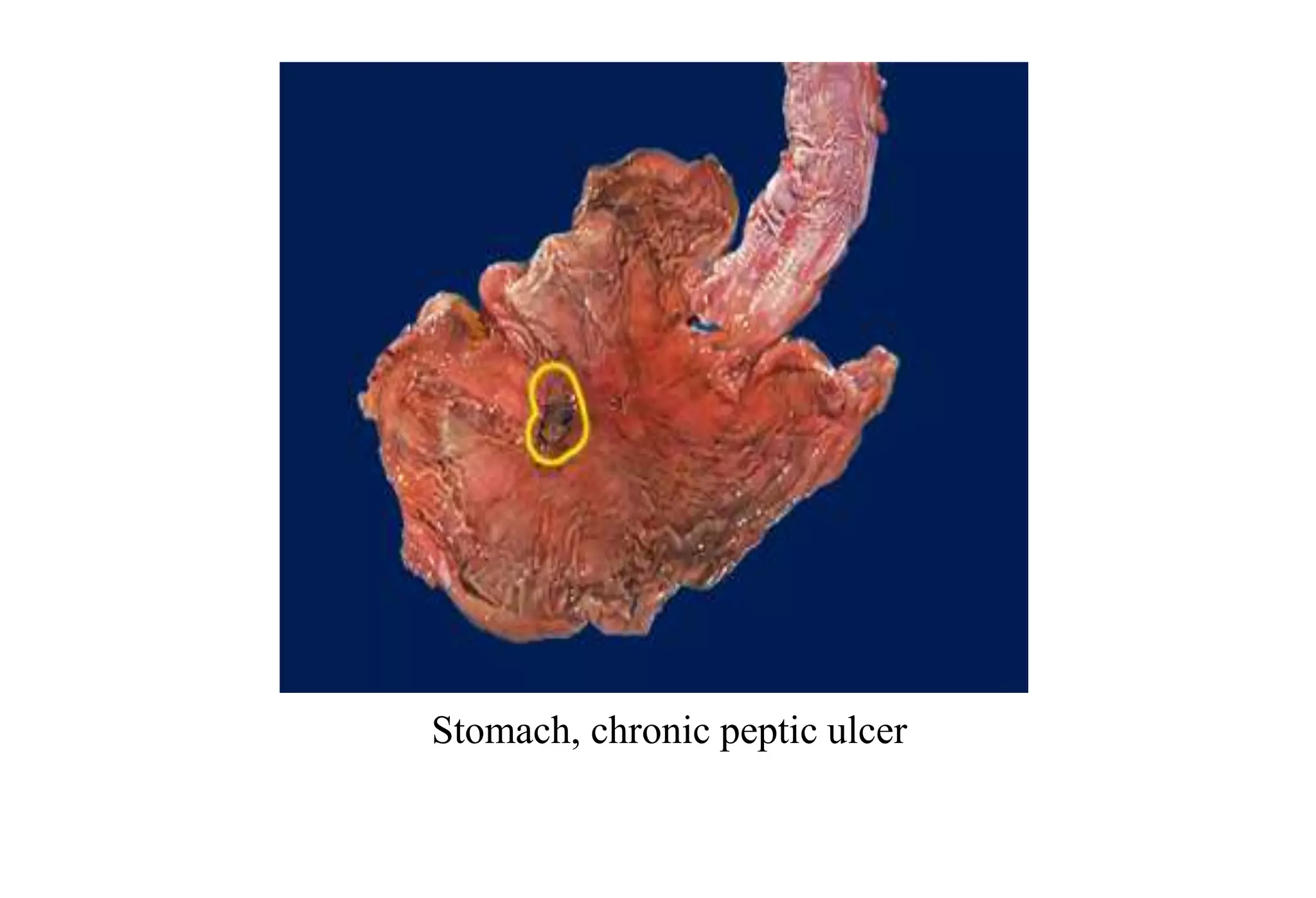 final peptic ulcer.pptx | Digestive Disorders | Diseases and Conditions