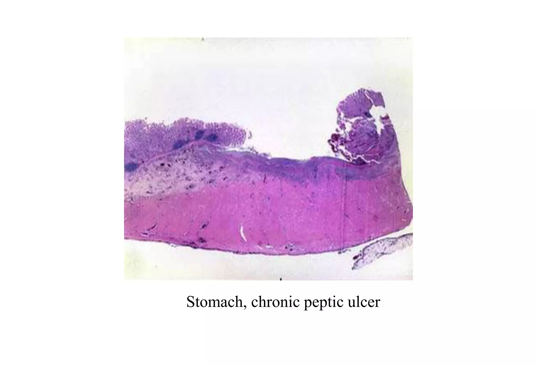 final peptic ulcer.pptx | Digestive Disorders | Diseases and Conditions