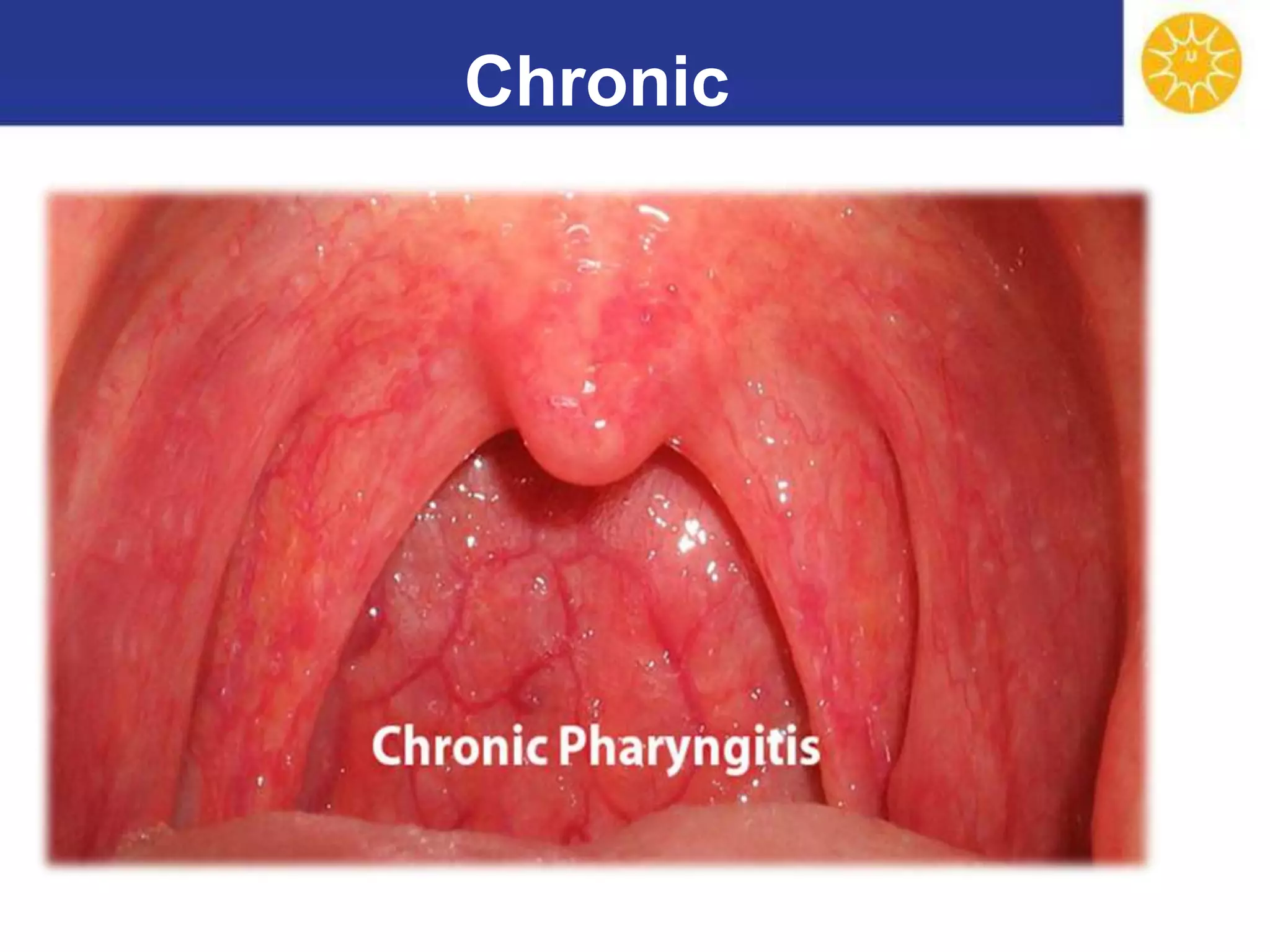 Final pharyngitis | PPT