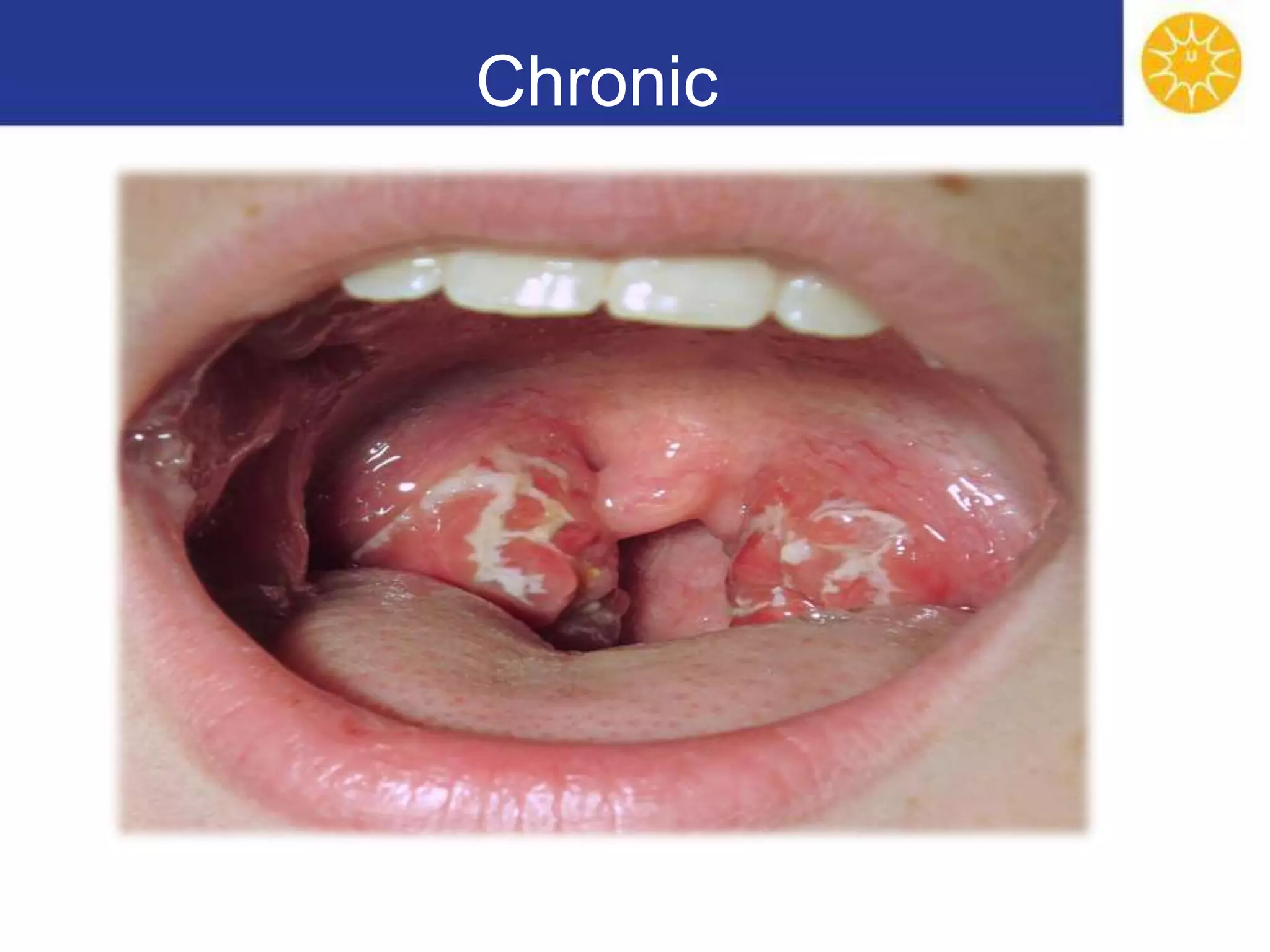 Final pharyngitis | PPT