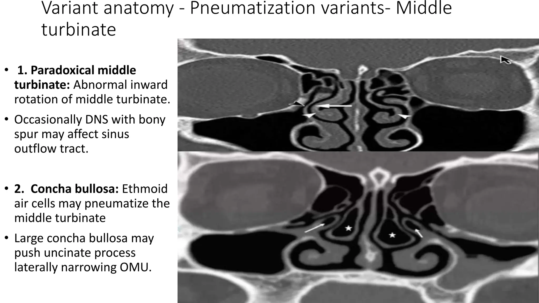 Overview of Paranasal sinus Radiology.pptx