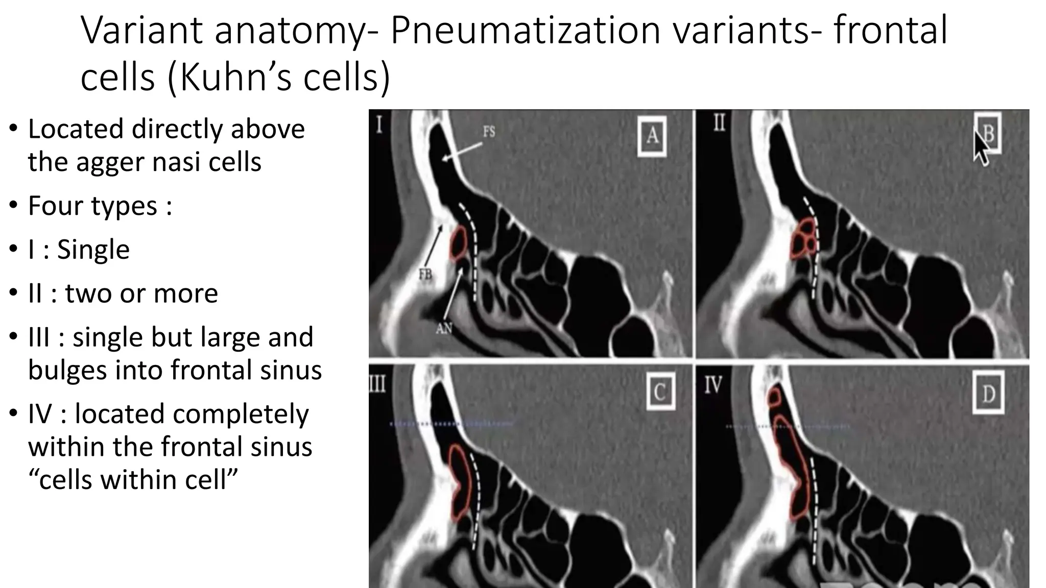Overview of Paranasal sinus Radiology.pptx