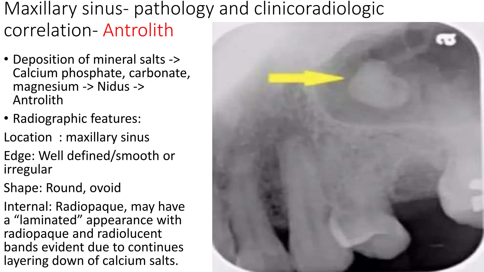 Overview of Paranasal sinus Radiology.pptx