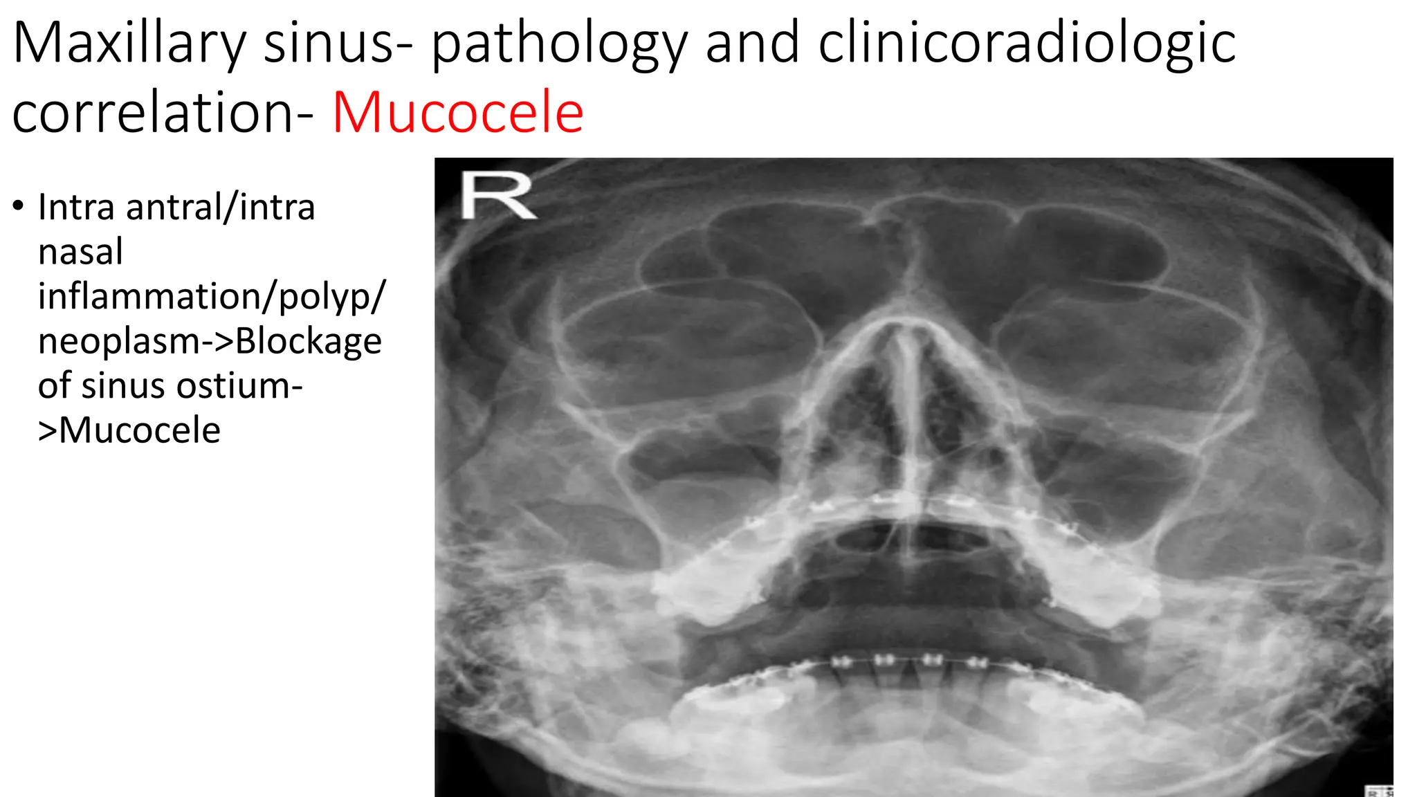 Overview of Paranasal sinus Radiology.pptx