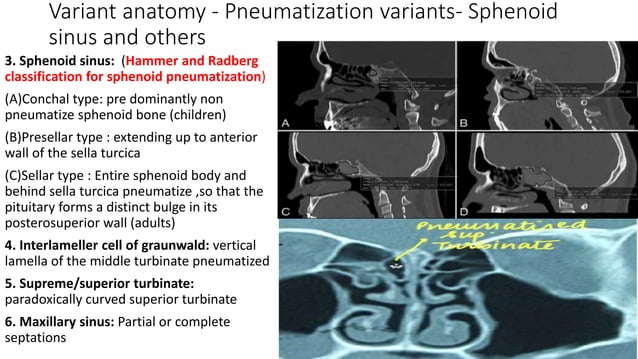 Overview of Paranasal sinus Radiology.pptx