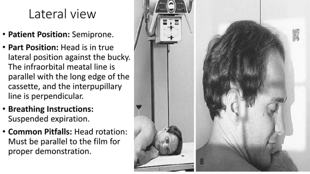 Overview of Paranasal sinus Radiology.pptx