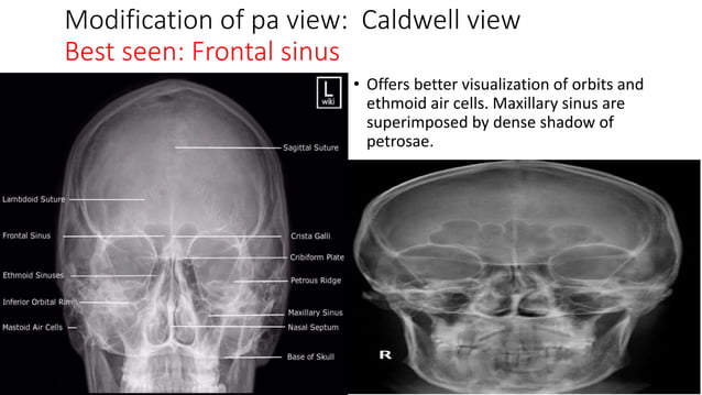 Overview of Paranasal sinus Radiology.pptx