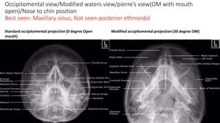 Overview of Paranasal sinus Radiology.pptx