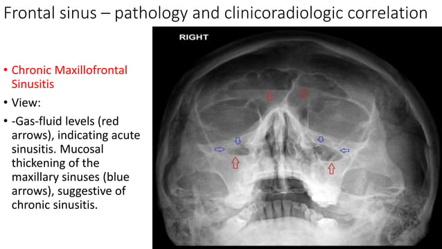 Overview of Paranasal sinus Radiology.pptx