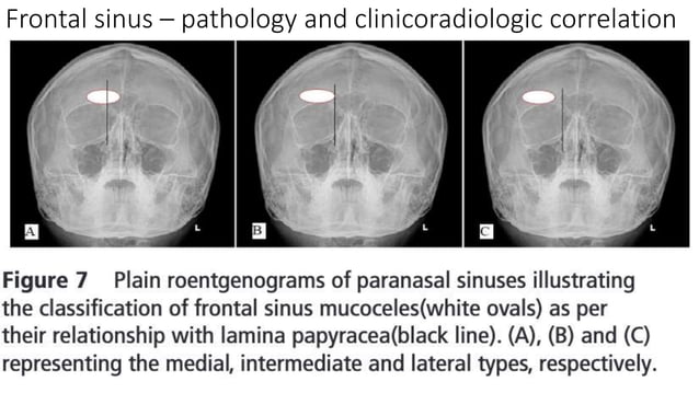 Overview of Paranasal sinus Radiology.pptx