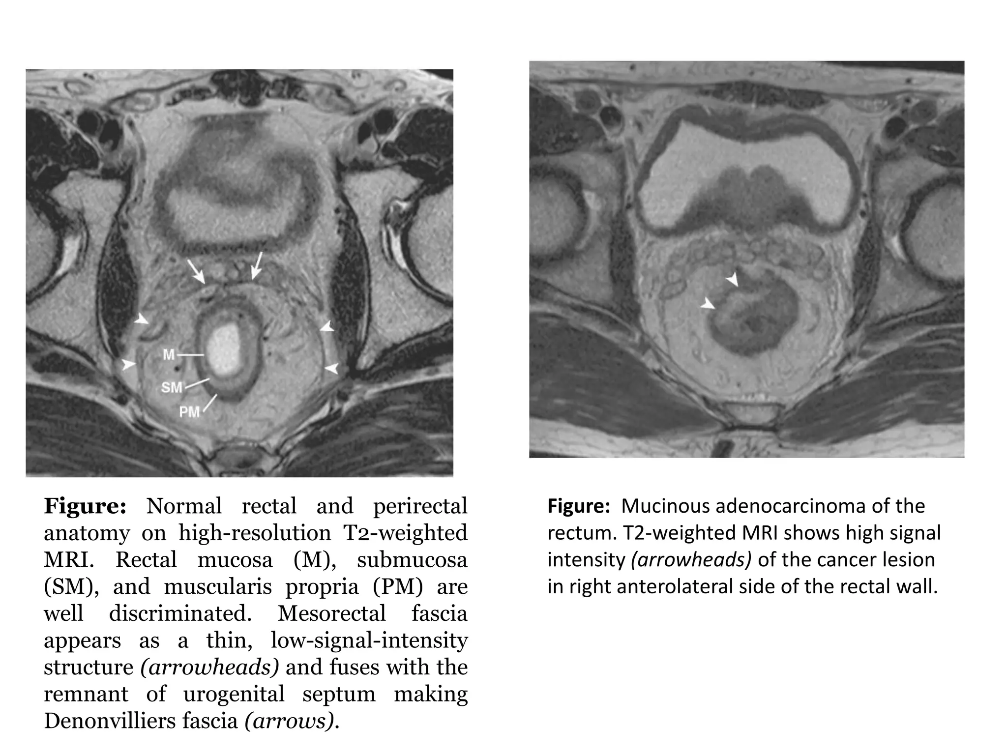 Rectal carcinoma approach | PPTX