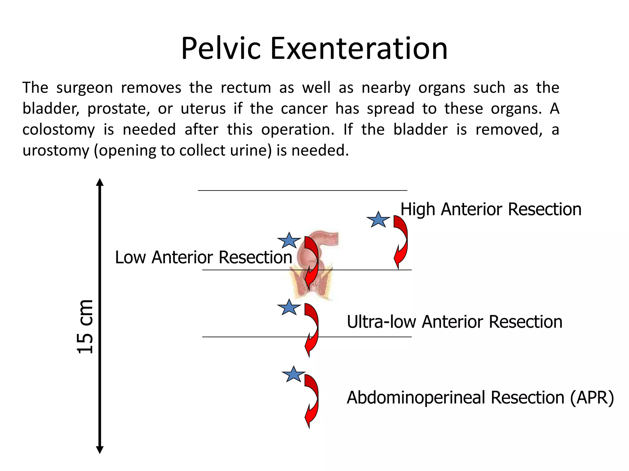 Rectal carcinoma approach | PPTX