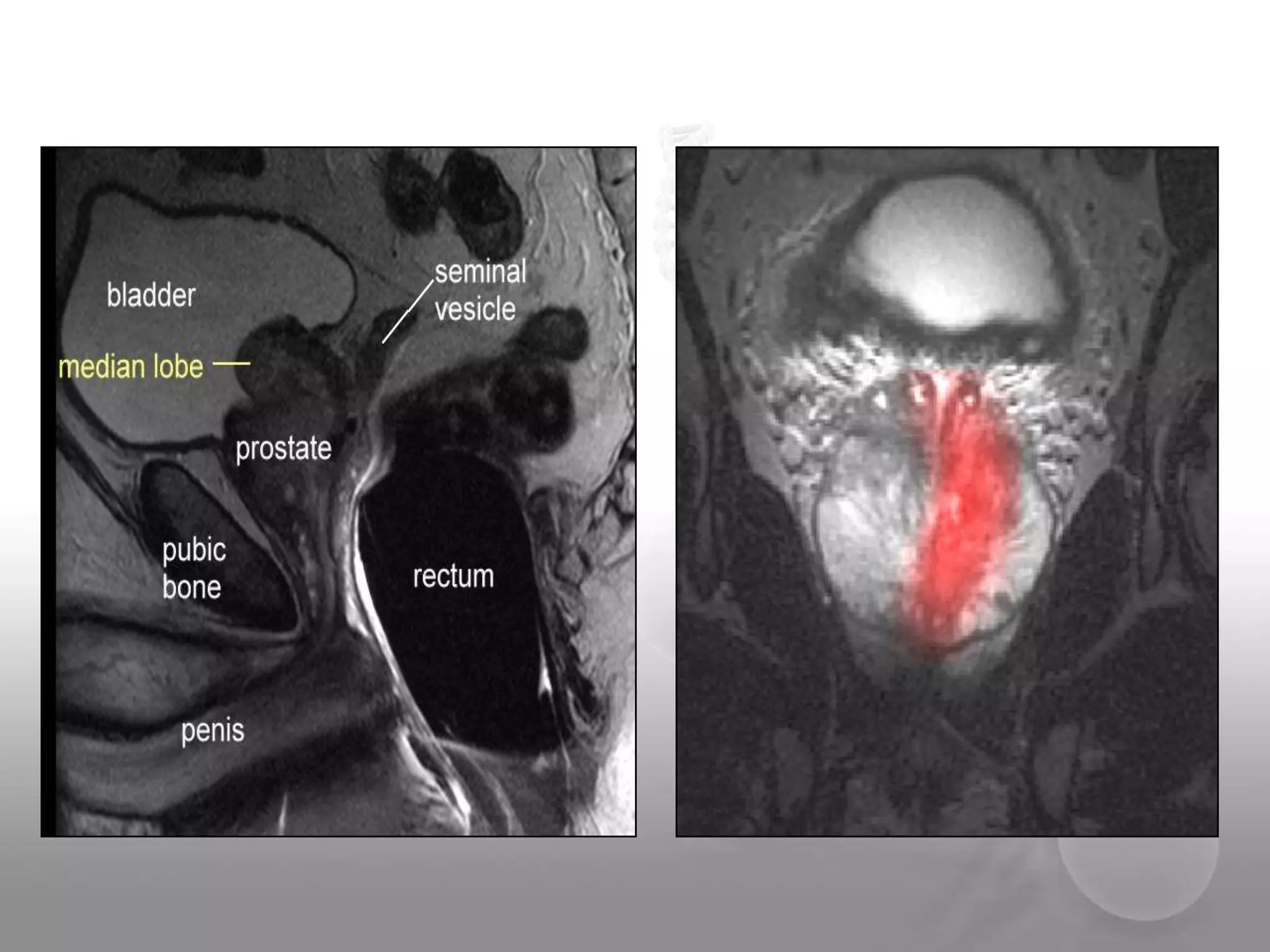 Radiation Therapy - Prostate Cancer | PPT