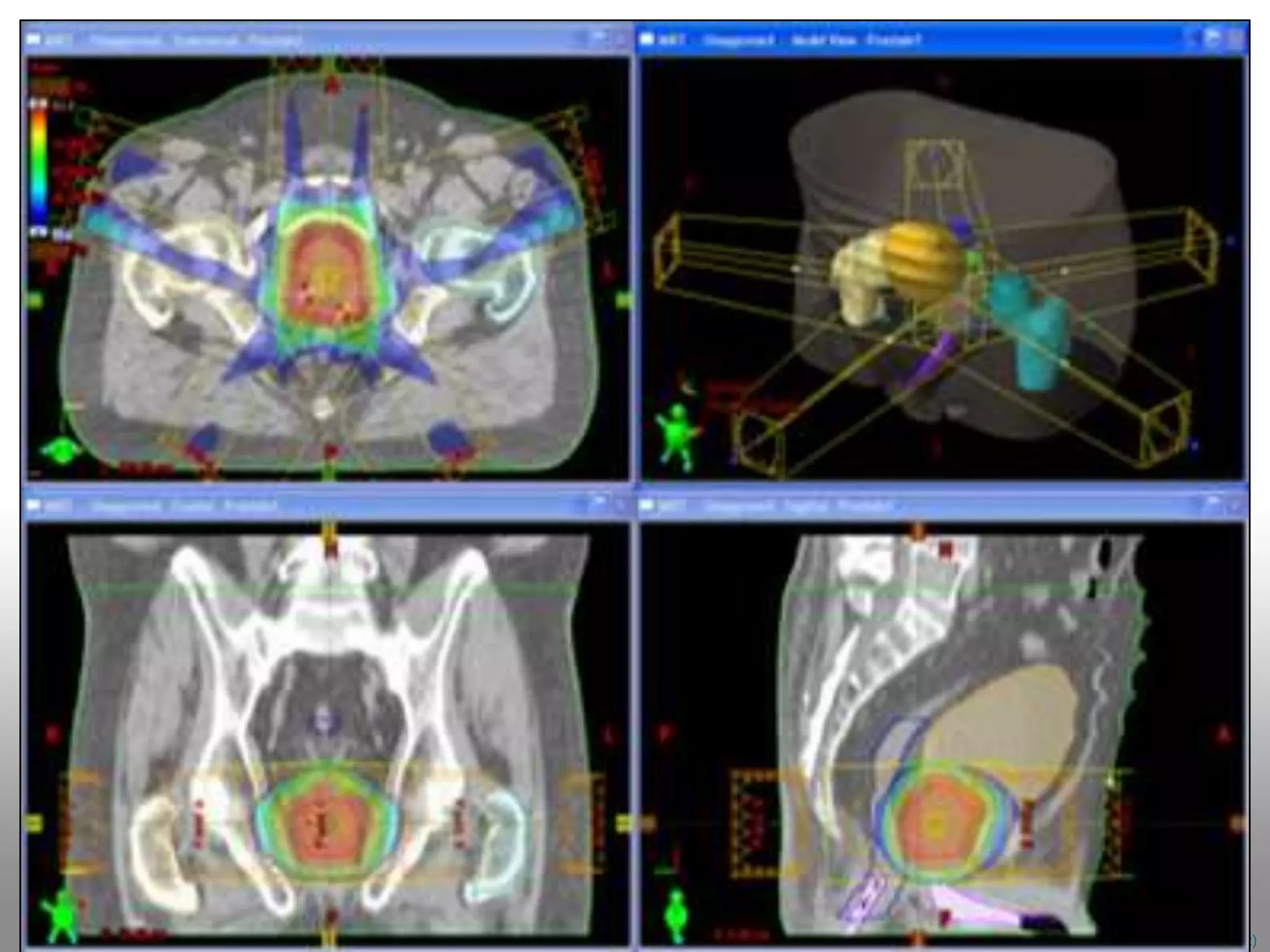 Radiation Therapy - Prostate Cancer | PPTX