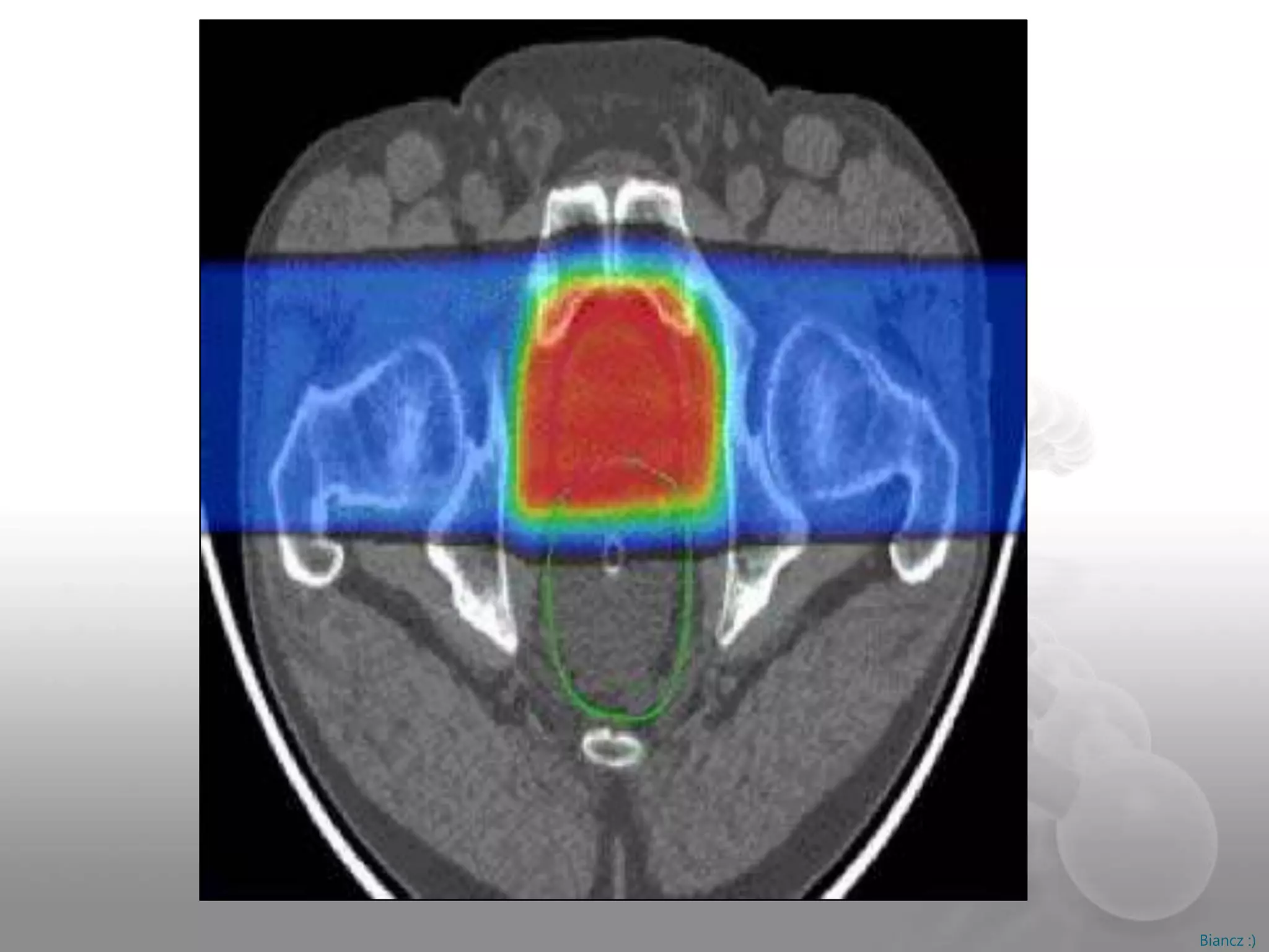 Radiation Therapy - Prostate Cancer | PPTX