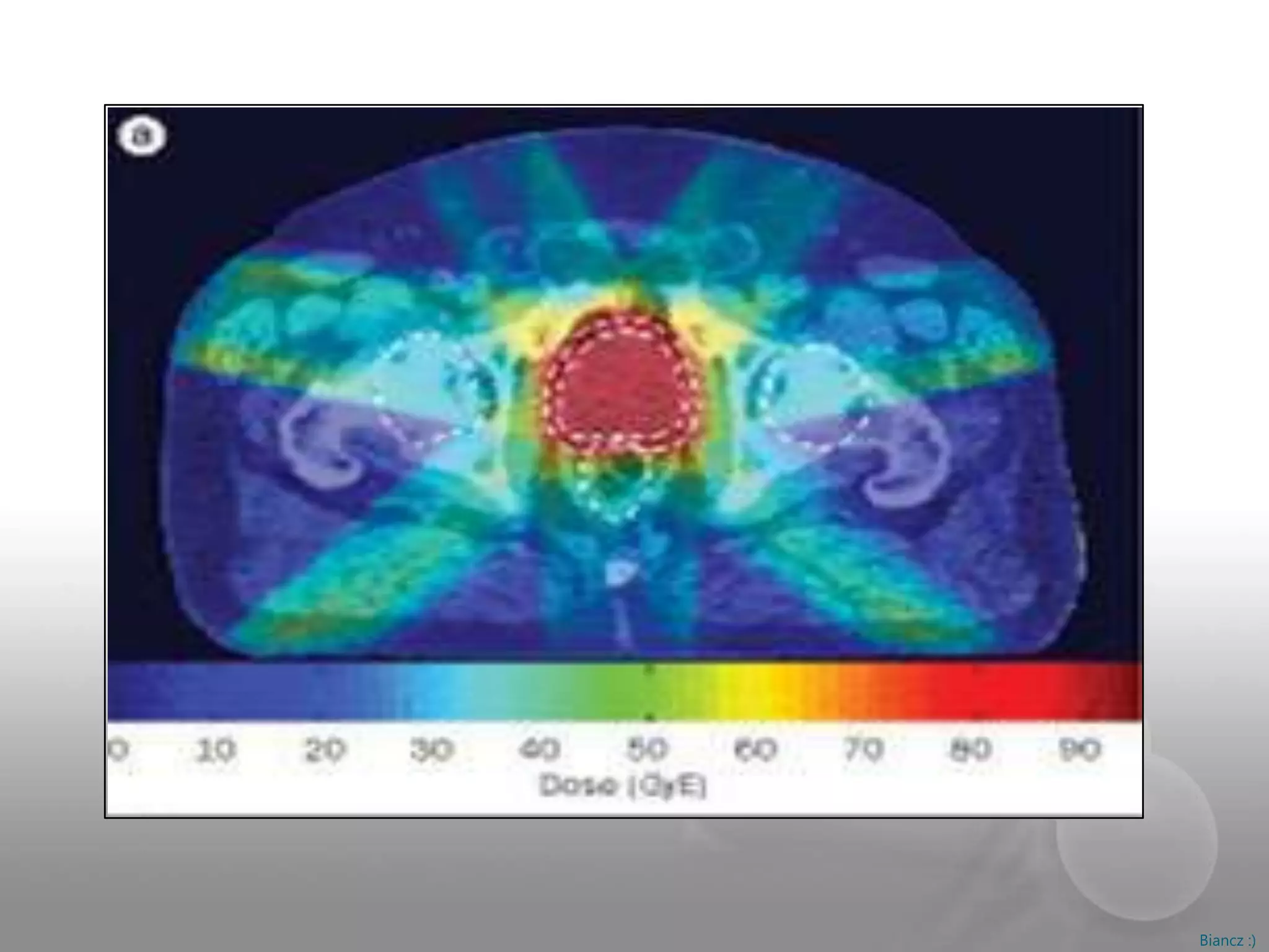 Radiation Therapy - Prostate Cancer | PPTX