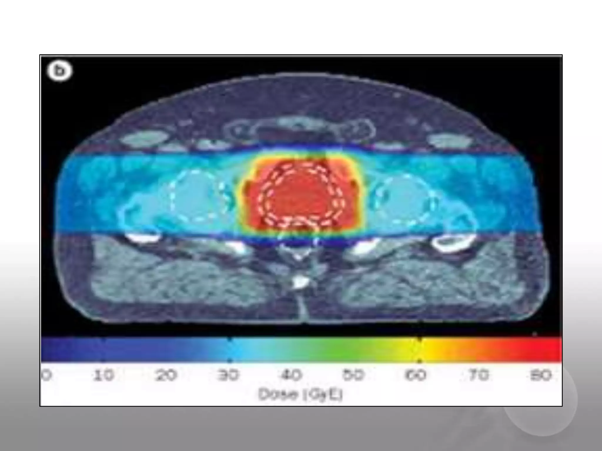 Radiation Therapy - Prostate Cancer | PPTX