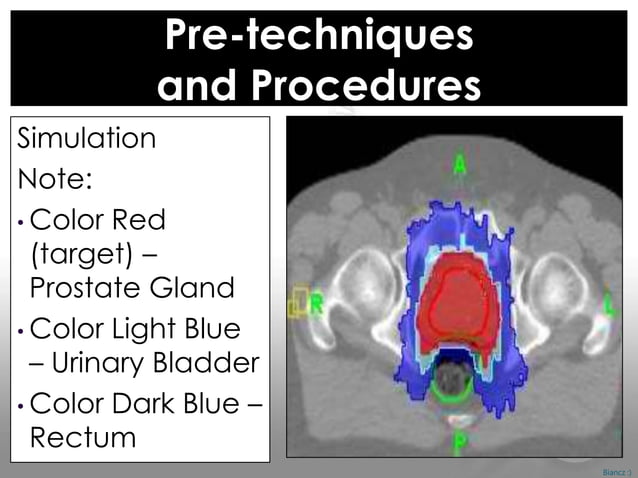 Radiation Therapy - Prostate Cancer | PPT