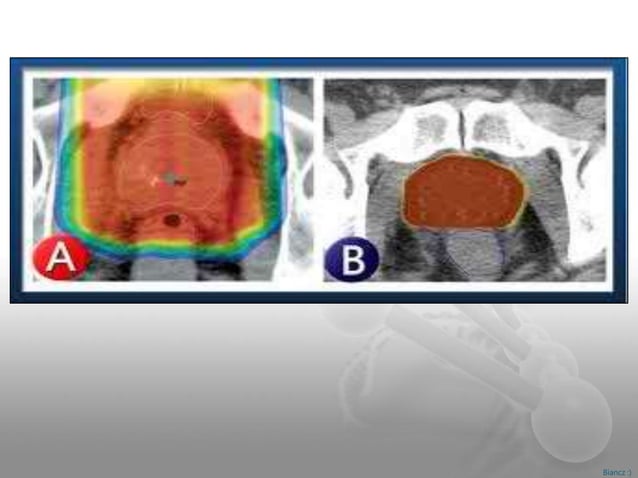 Radiation Therapy - Prostate Cancer | PPT