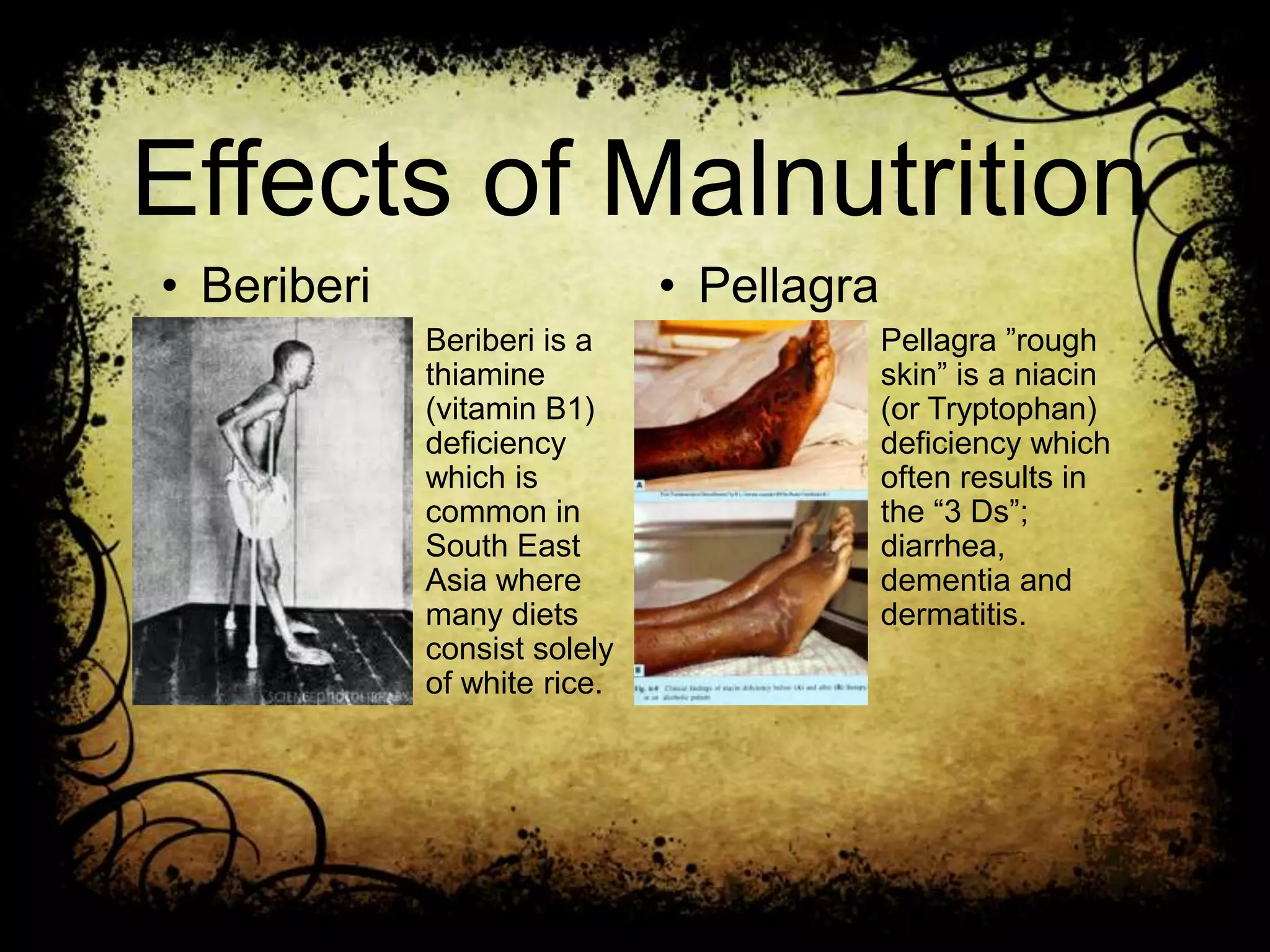 malnourishment in poor and healthy eating habits | PPTX