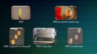 platelet concentrates in dentistry | PPTX