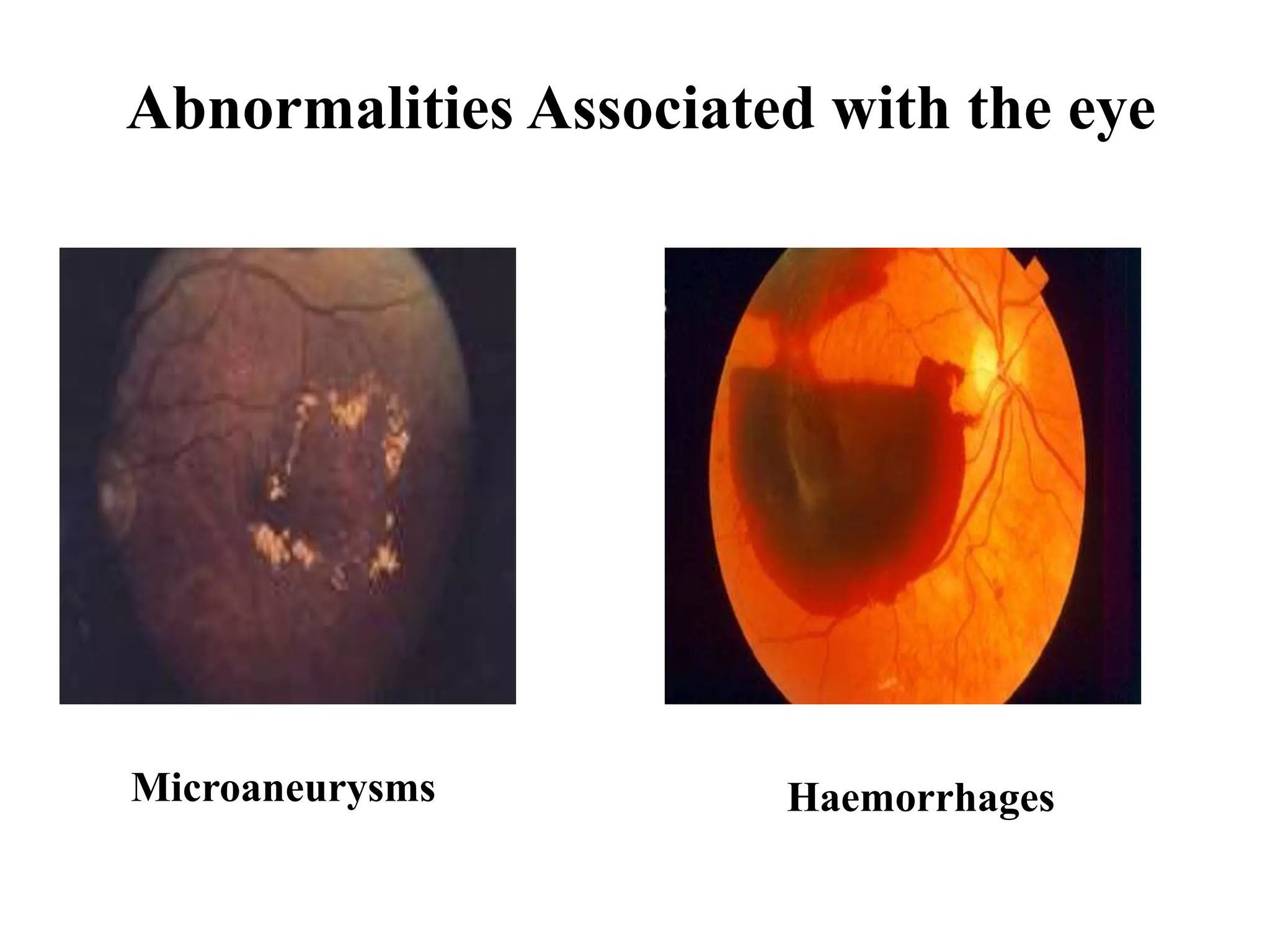 Diabetic Retinopathy Analysis using Fundus Image | PPTX