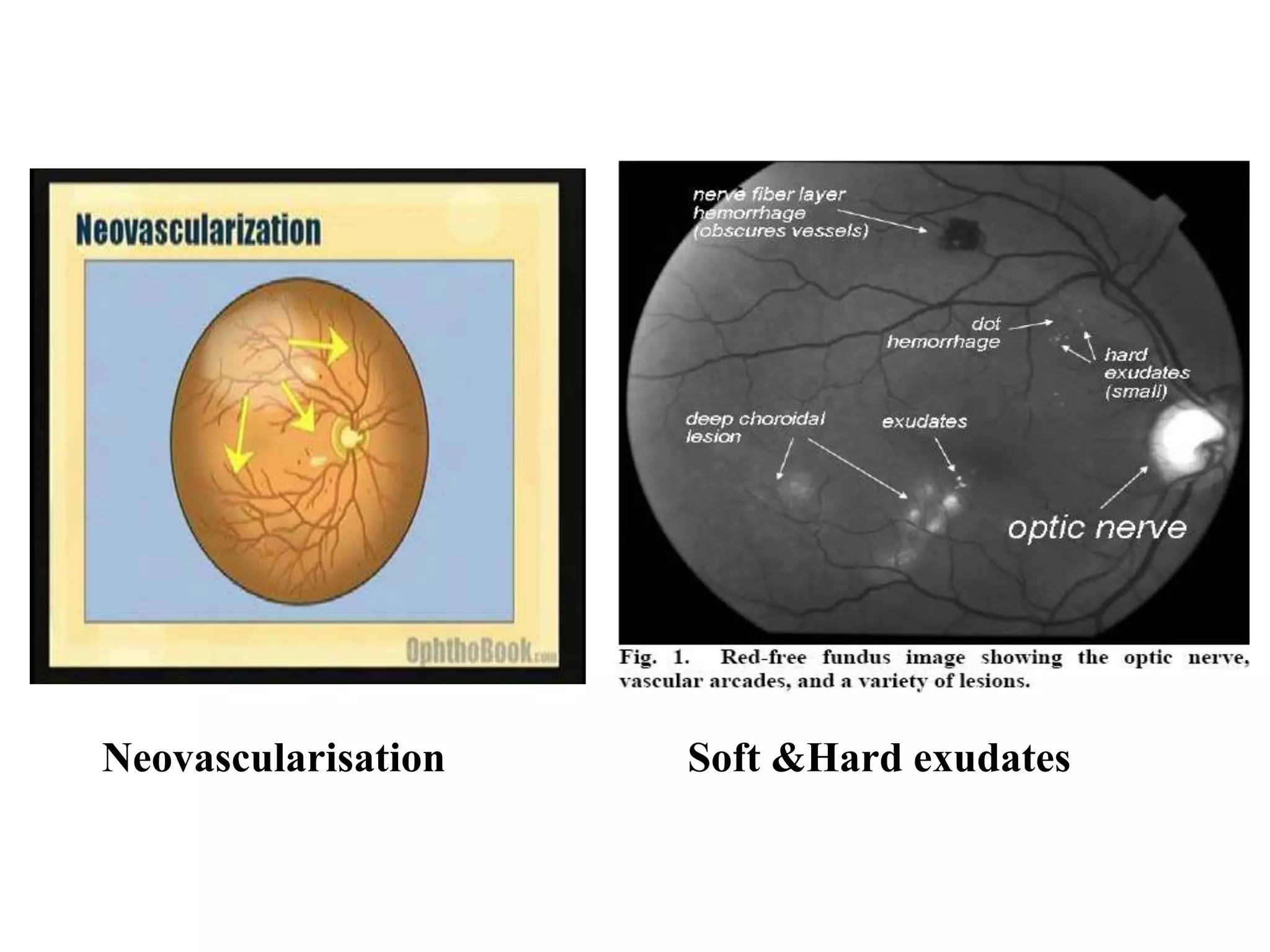 Diabetic Retinopathy Analysis using Fundus Image | PPTX