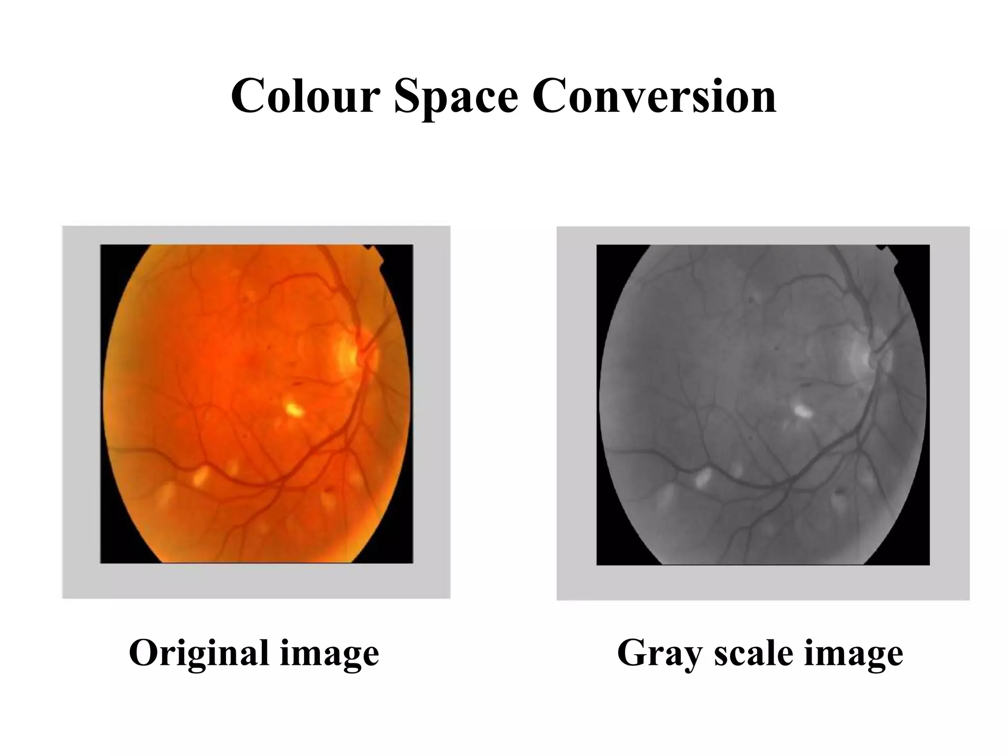 Diabetic Retinopathy Analysis using Fundus Image | PPTX