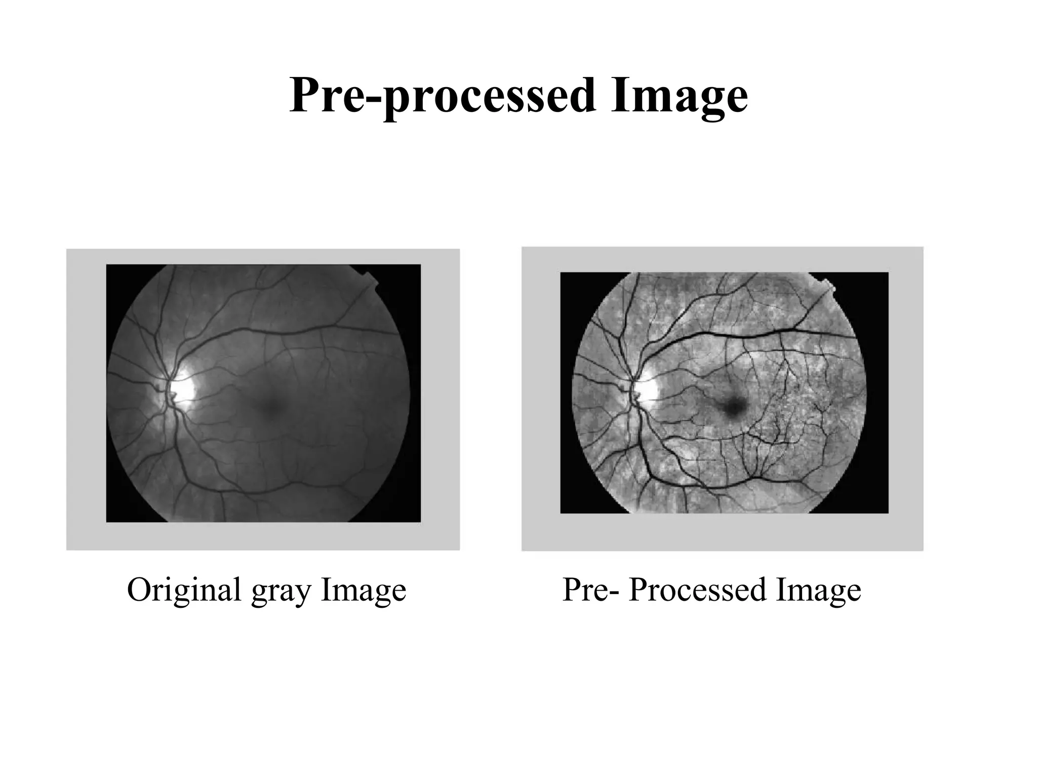 Diabetic Retinopathy Analysis using Fundus Image | PPTX