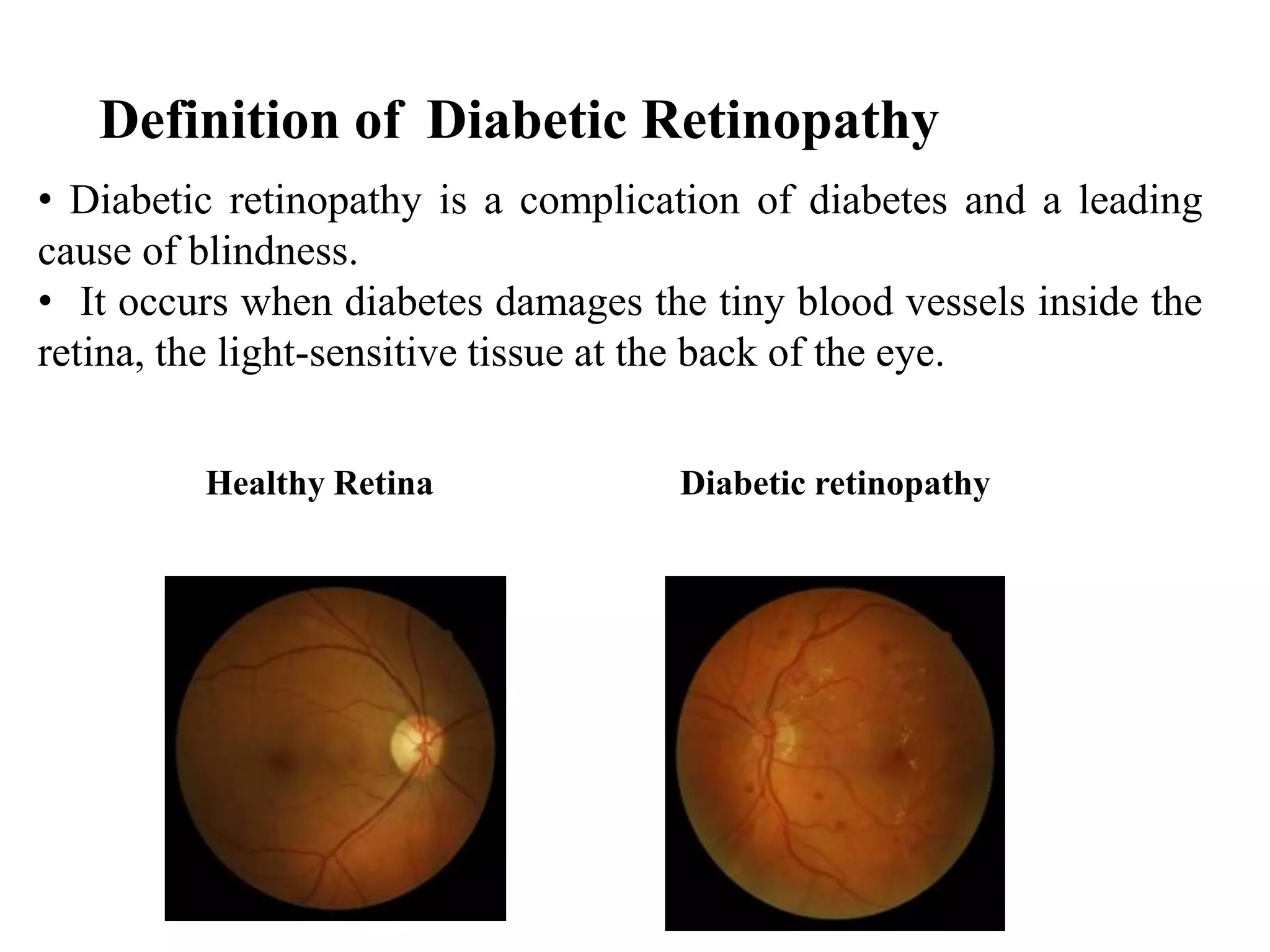 Diabetic Retinopathy Analysis using Fundus Image | PPTX