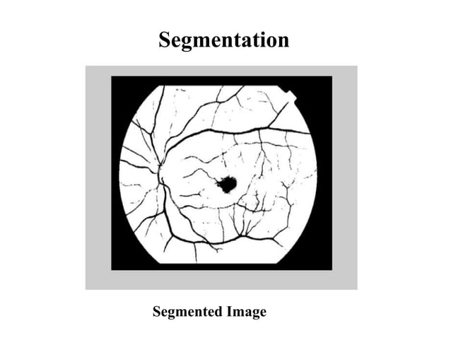 Diabetic Retinopathy Analysis using Fundus Image | PPTX | Eye and Vision Conditions | Diseases ...