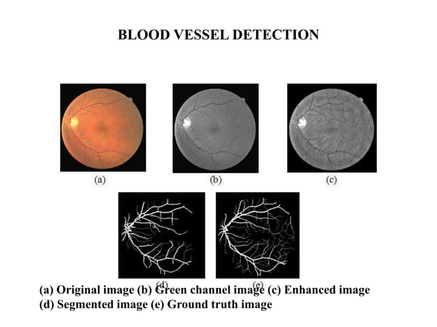 Diabetic Retinopathy Analysis using Fundus Image | PPTX | Eye and Vision Conditions | Diseases ...