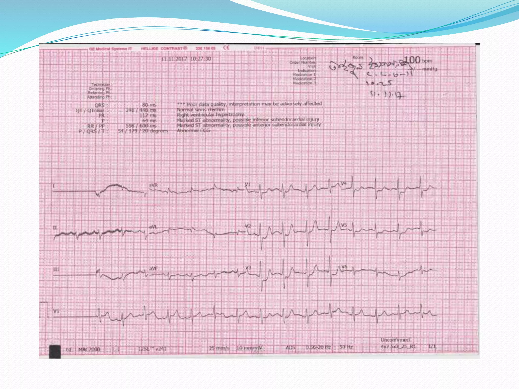 Right ventricular infarction & posterior extension by dr salim | PPTX