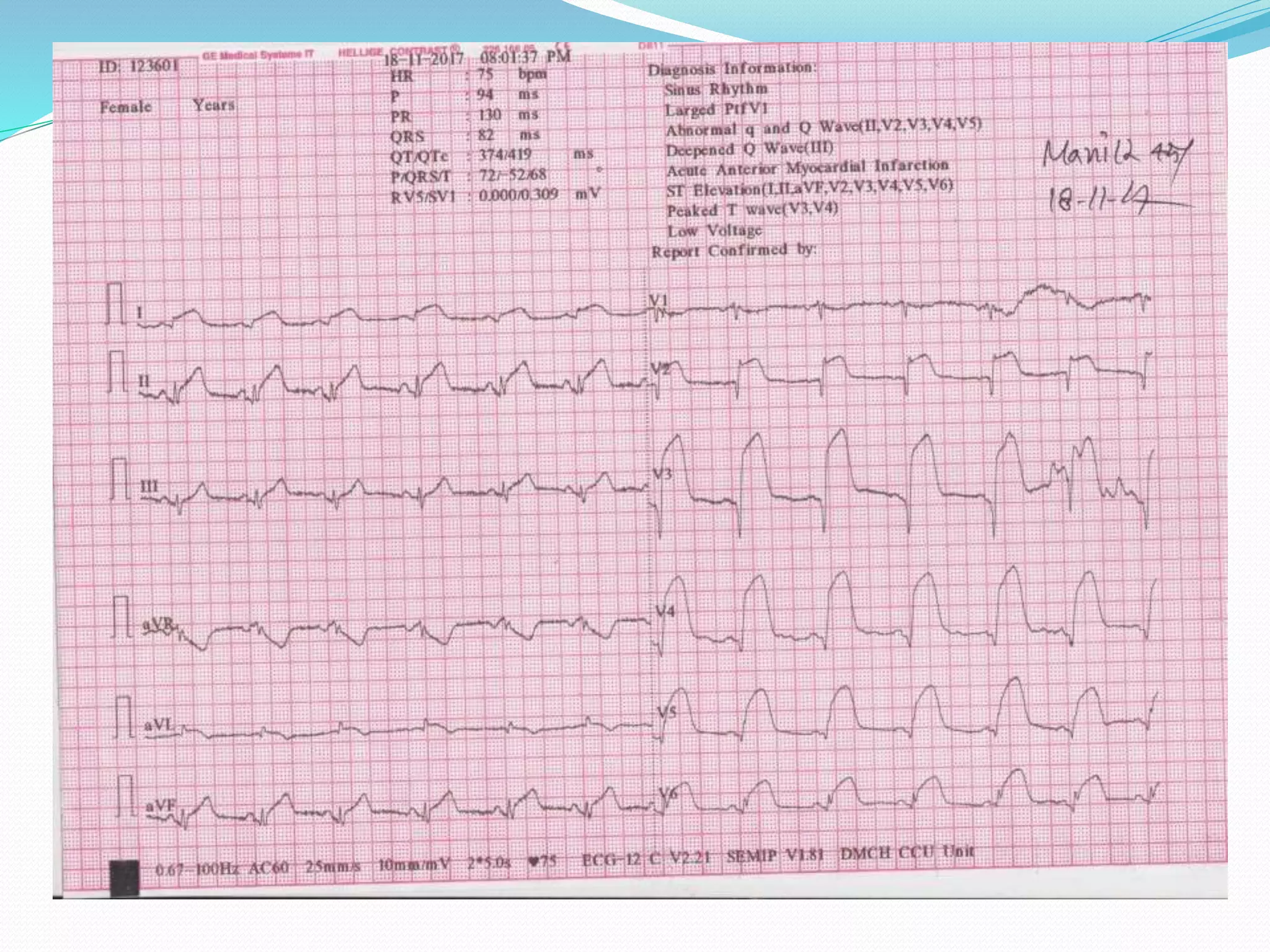 Right ventricular infarction & posterior extension by dr salim | PPTX