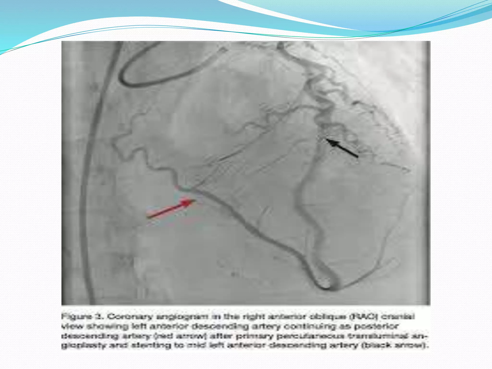 Right ventricular infarction & posterior extension by dr salim | PPTX