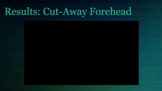 Drop Test Simulation of a Head Model | PPTX