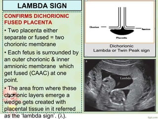 ROLE OF ULTRASOUND IN MULTIFETAL GESTATION - WHAT AN OBSTETRICIAN ...