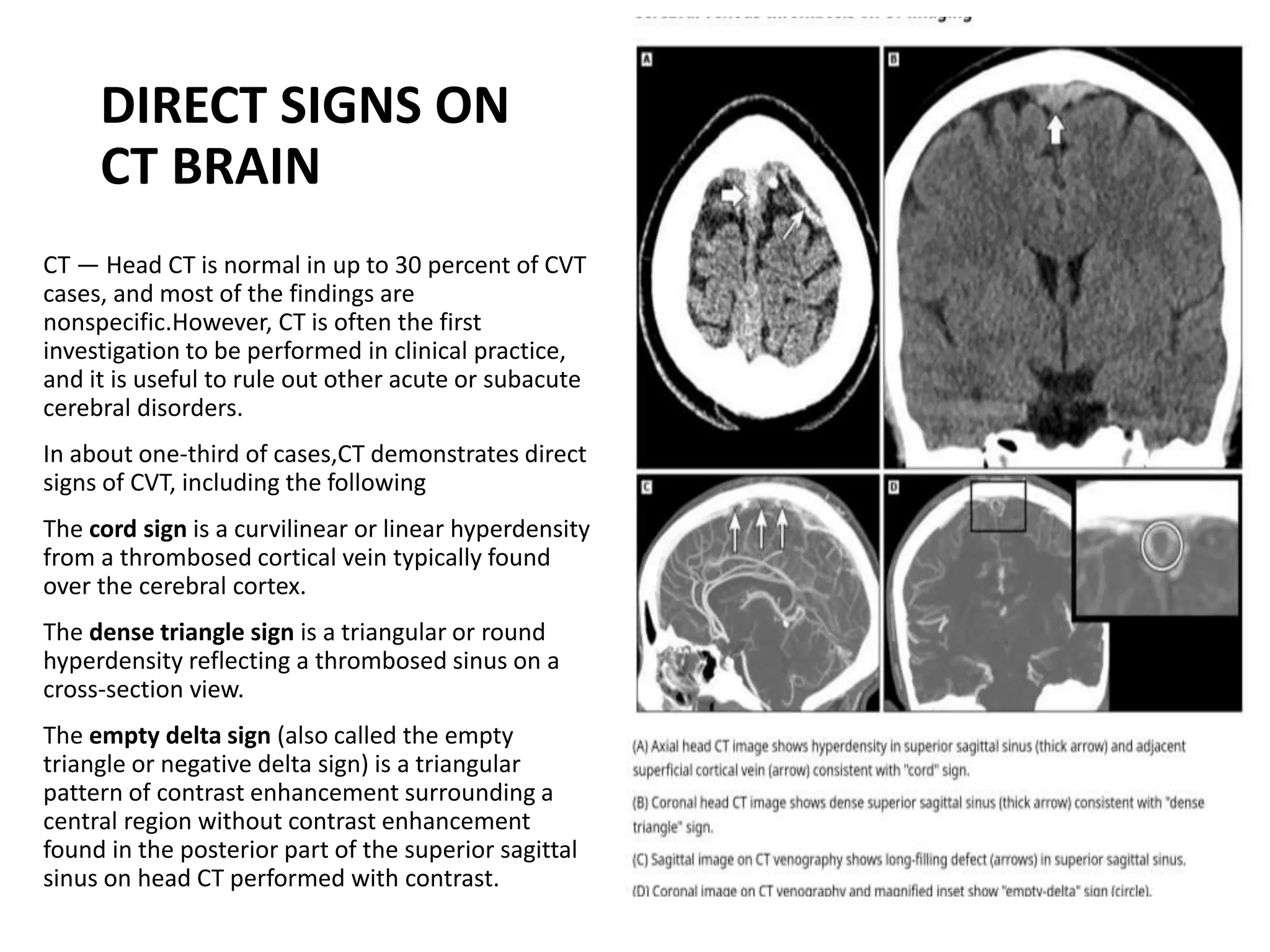 CVST central venous sinus thrombosis.pptx