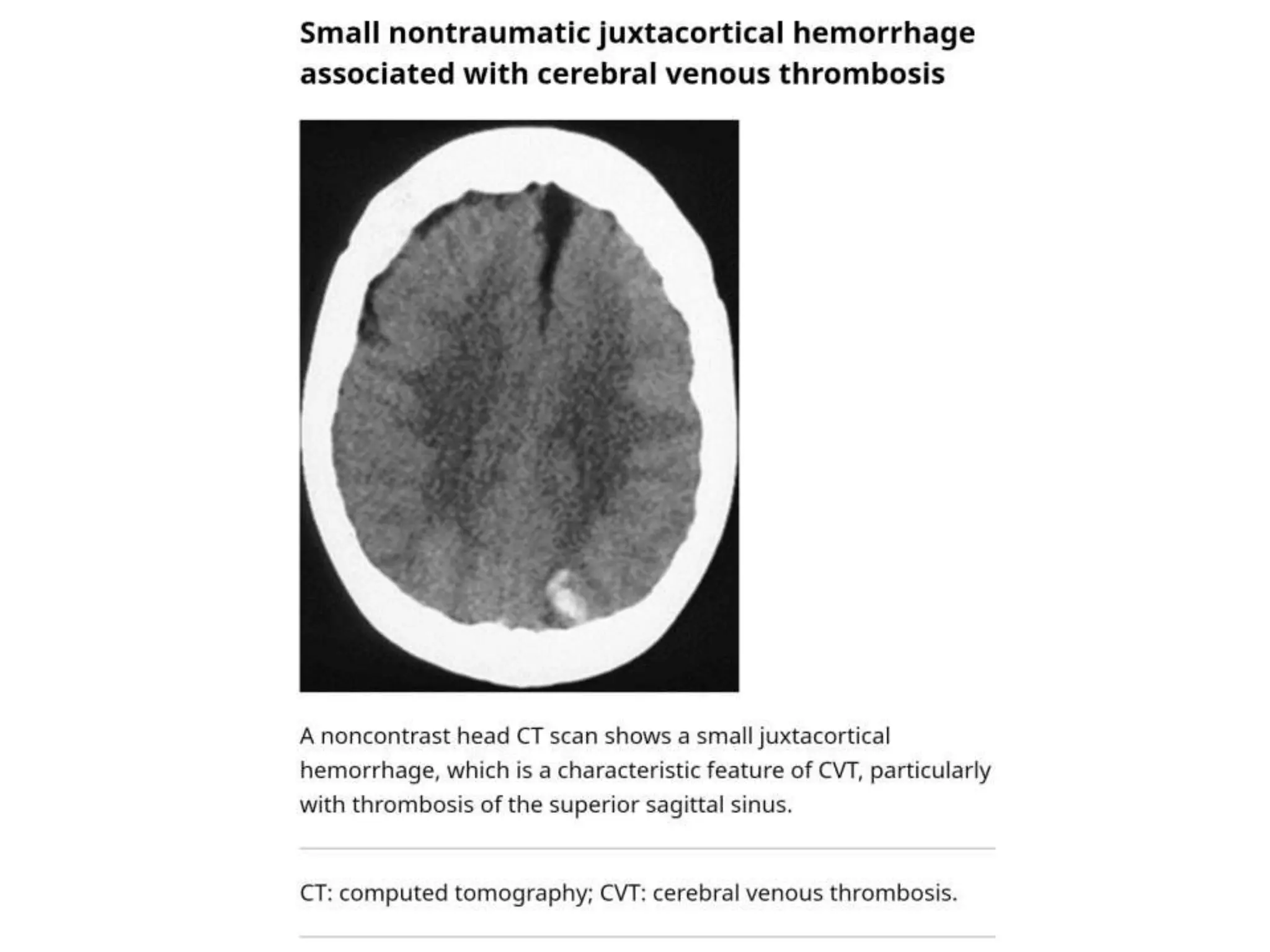 CVST central venous sinus thrombosis.pptx
