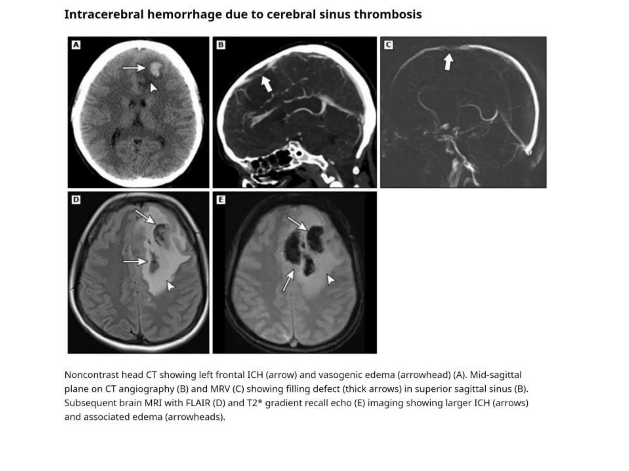 CVST central venous sinus thrombosis.pptx