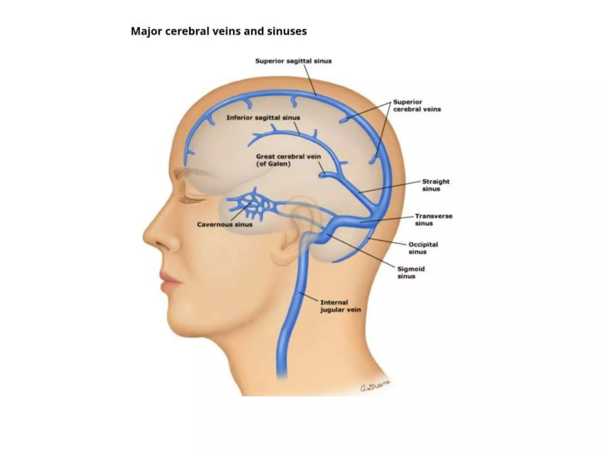 CVST central venous sinus thrombosis.pptx | Ear, Nose and Throat ...