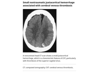 CVST central venous sinus thrombosis.pptx
