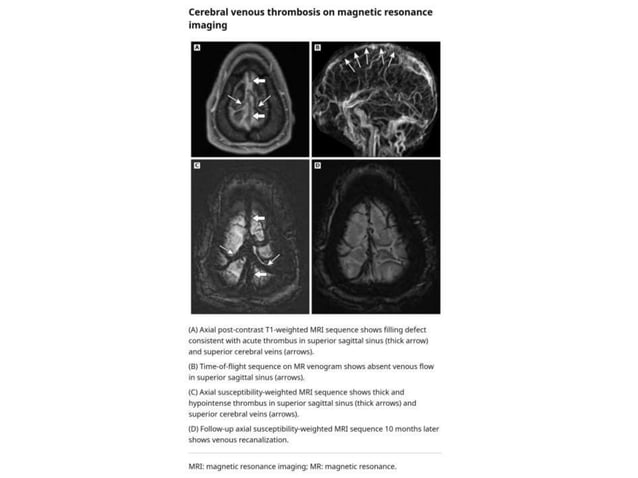 CVST central venous sinus thrombosis.pptx | Ear, Nose and Throat ...