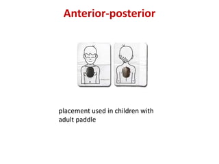 Defibrilation | PPTX