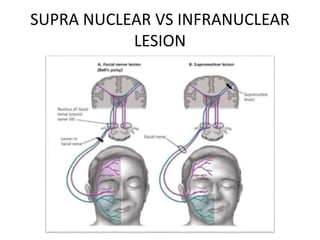facial nerve- pathophysiology, electrodiagnostic and imaging | PPT
